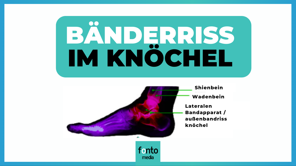 Bänderriss im Knöchel : Heilungsdauer und wichtige Fakten
