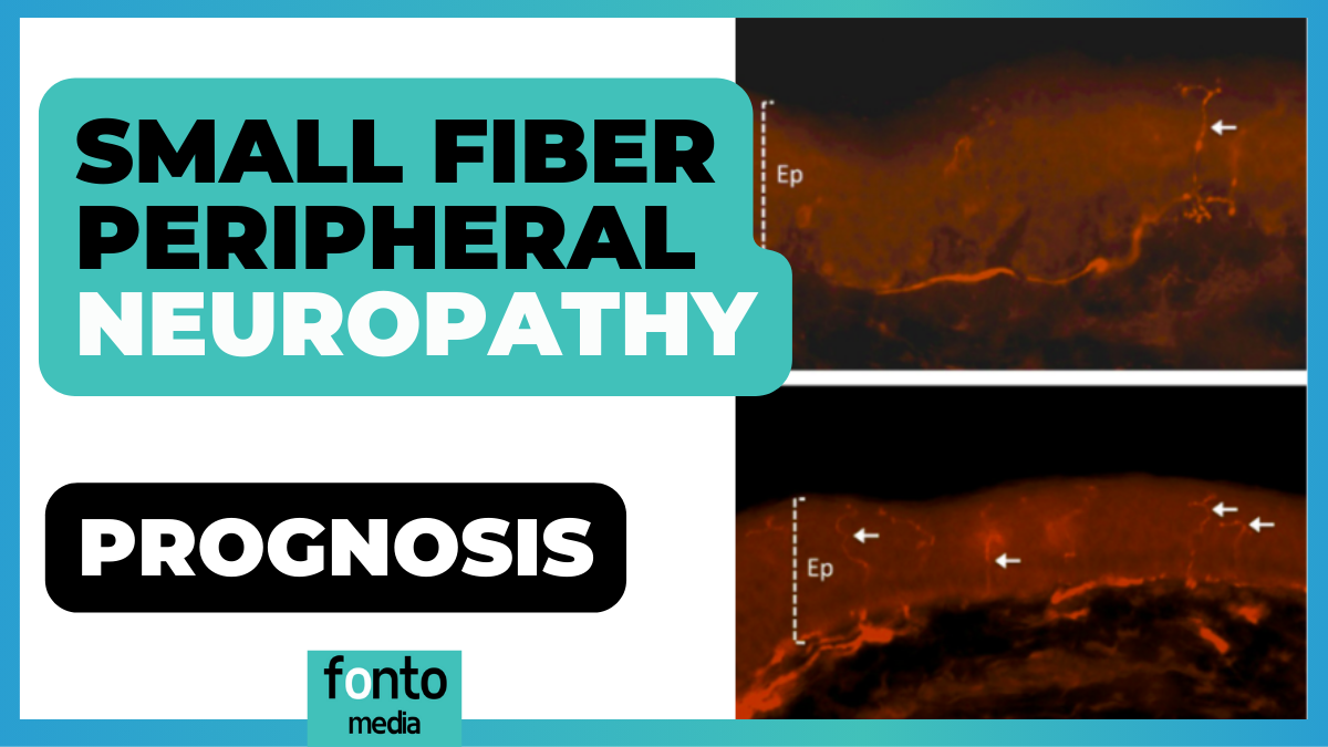 Small Fiber Peripheral Neuropathy: Prognosis (What Studies Say)