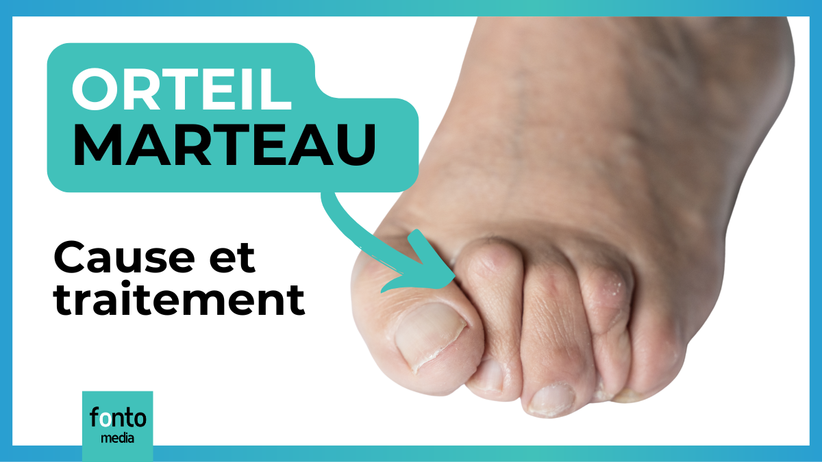 Orteil marteau : cause et que faire